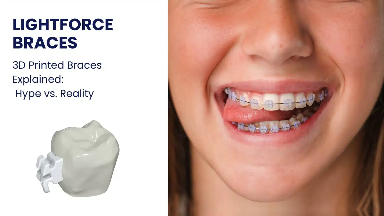 LightForce Braces: Benefits, Myths, Cost & Alternatives